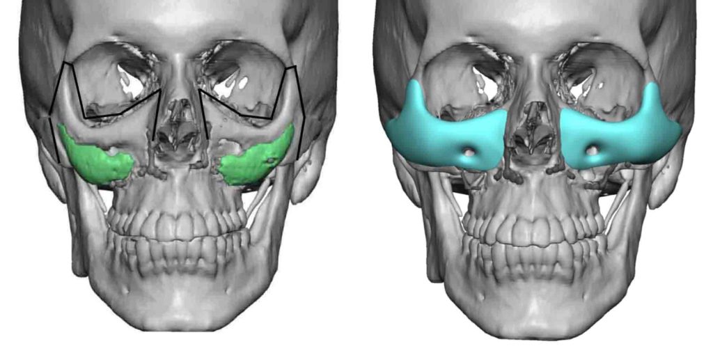 Plastic Surgery Case Study - Custom Infraorbital-Maxillary-Malar ...