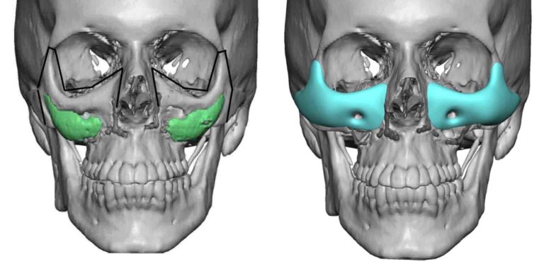 Custom Infraorbital-Maxillary-Malar Implant simulartng LeFort III ...