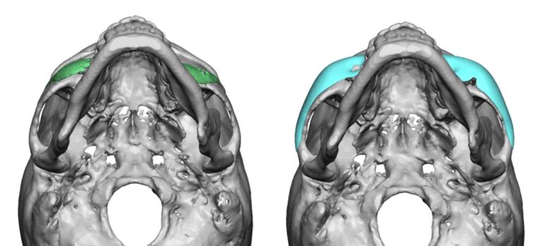 Plastic Surgery Case Study - Custom Infraorbital-Maxillary-Malar ...