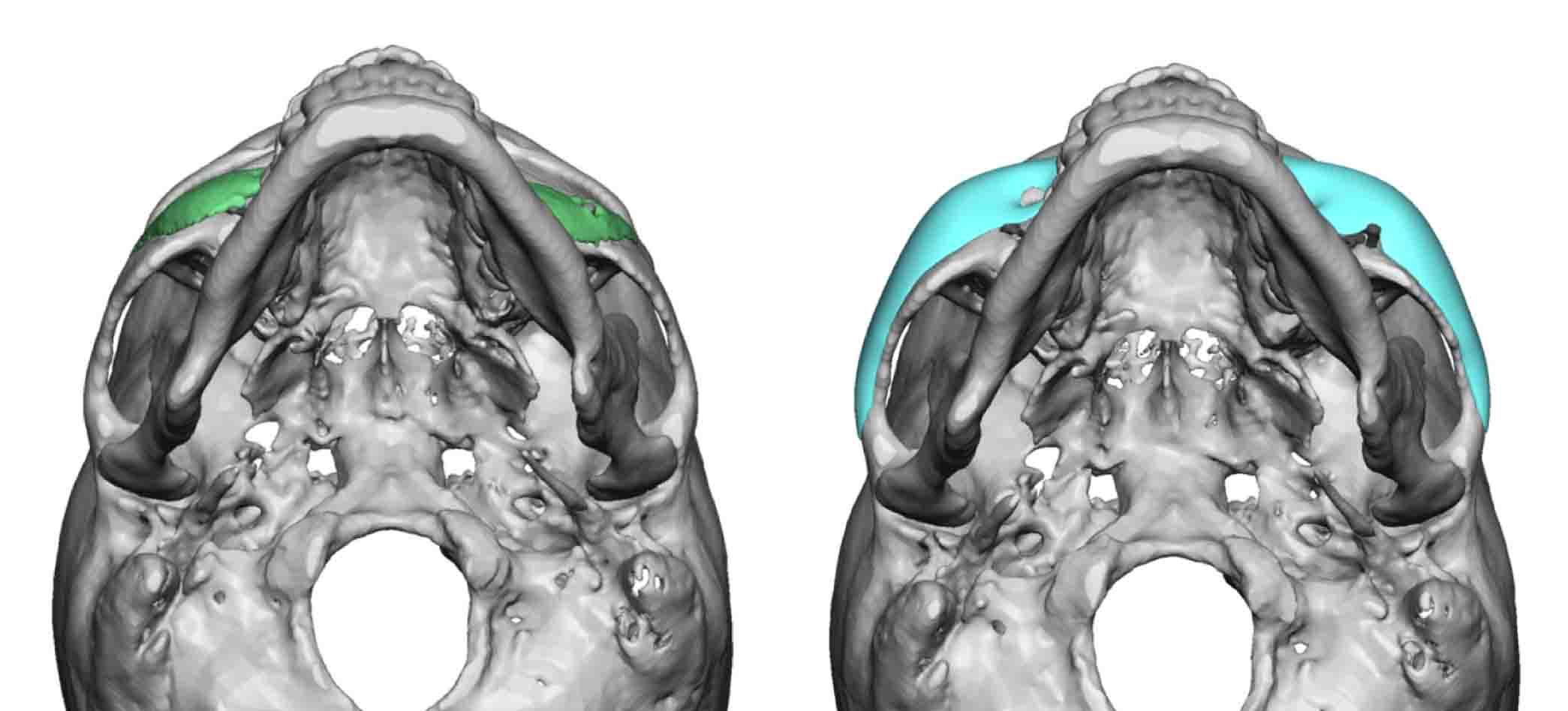 Custom Infraorbital-Maxillary-Malar Implants design after LeFort I ...