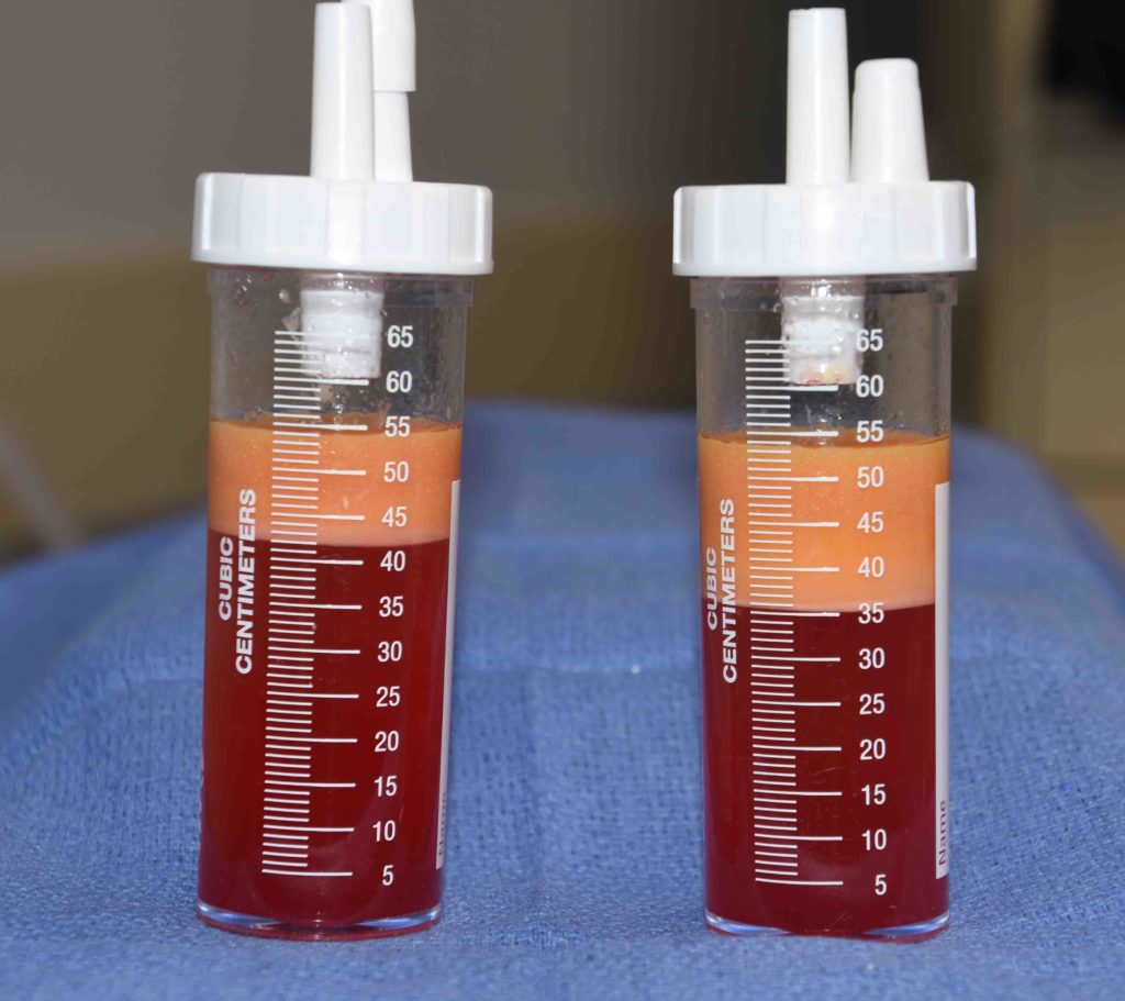 Technical Strategies - Gravity Decantation in Facial Fat Injection ...