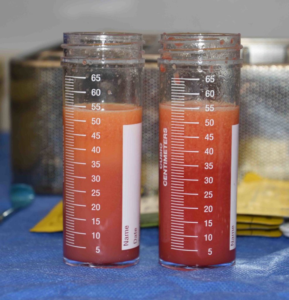 Technical Strategies - Gravity Decantation in Facial Fat Injection ...