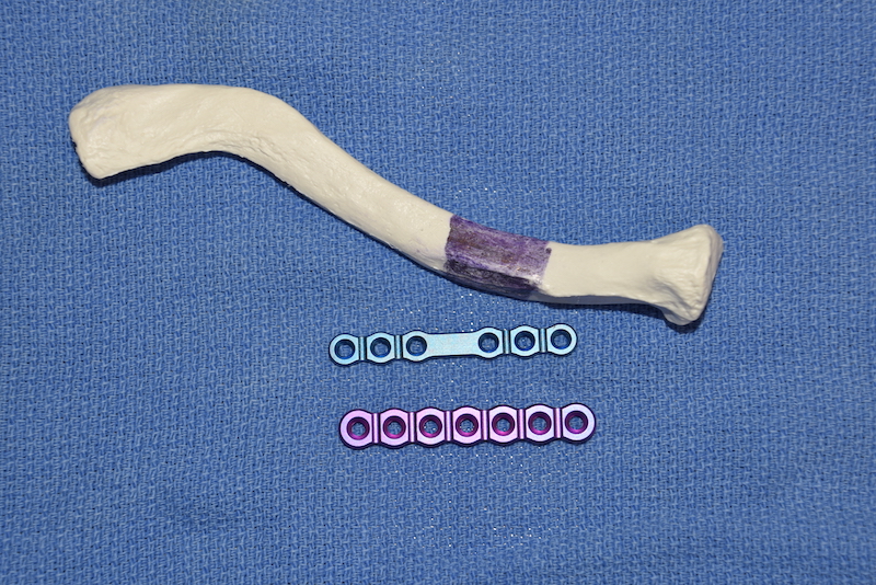 Technical Strategies - Plate and Screw Fixation of Clavicle Osteotomies ...