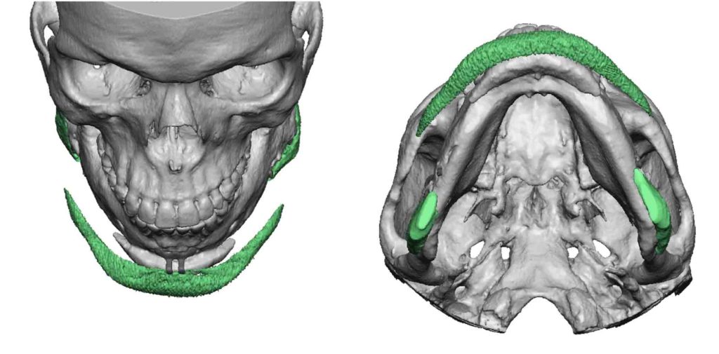 Inadequate standard chin and jaw angle implants 3D CT scan top and ...