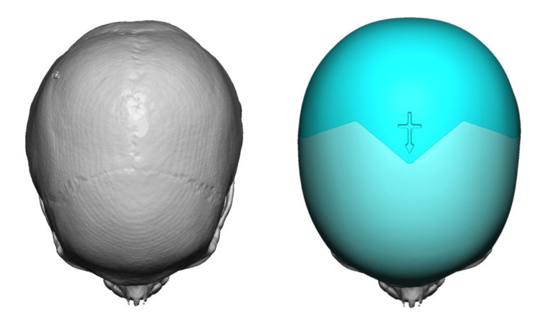 Plastic Surgery Case Study - Two Piece Custom Skull Implant for ...