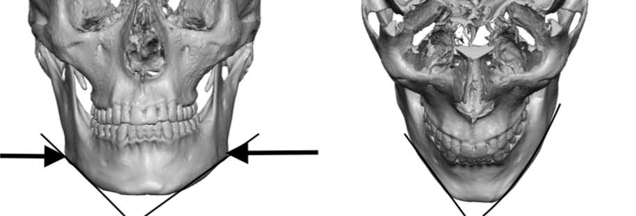Plastic Surgery Case Study - Custom Jawline Implant and Lower Jaw ...