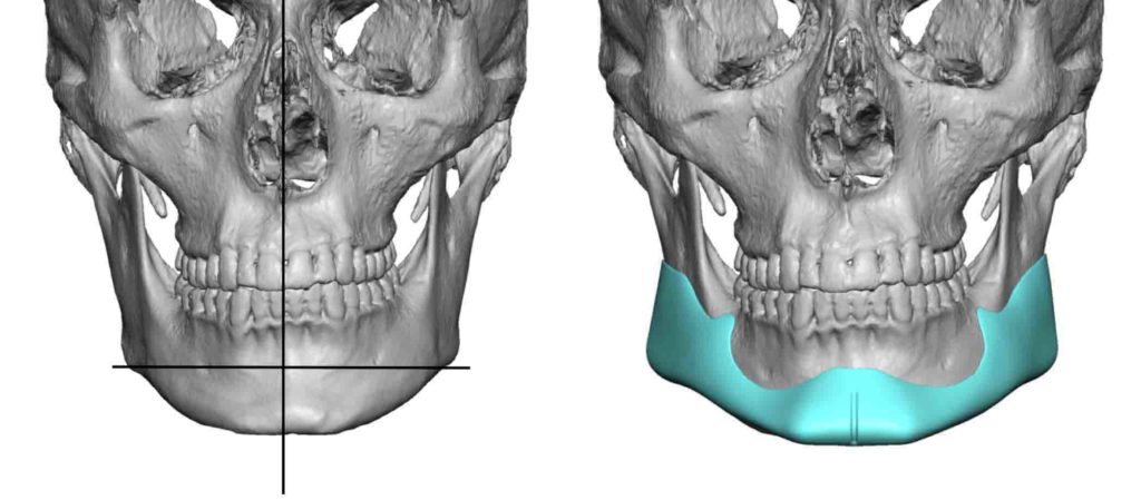 Plastic Surgery Case Study - Custom Jawline Implant and Lower Jaw ...
