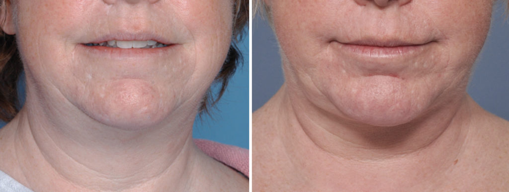 Plastic Surgery Case Study - The Value of the Submentoplasty Component ...