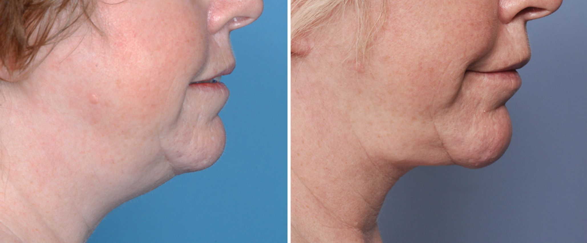 Necklift result side view Dr Barry Eppley Indianapolis - Explore ...