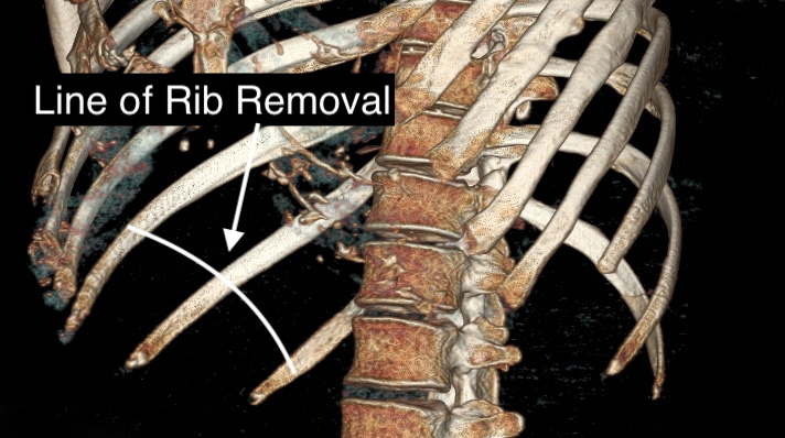 Rib Removal in Waist Narrowing Surgery and The Misconception of Loss of ...
