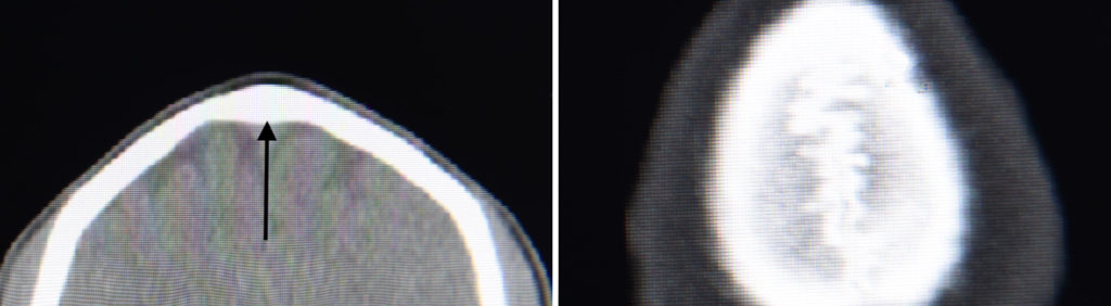 Plastic Surgery Case Study - Sagittal Crest Skull Reduction Using A ...