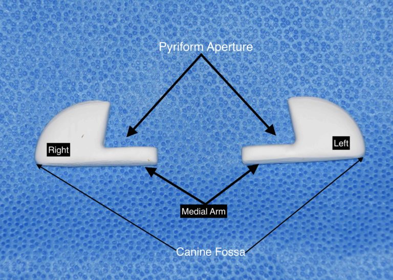 Surgical Placement of Preformed ePTFE Paranasal-Nasolabial Implants ...