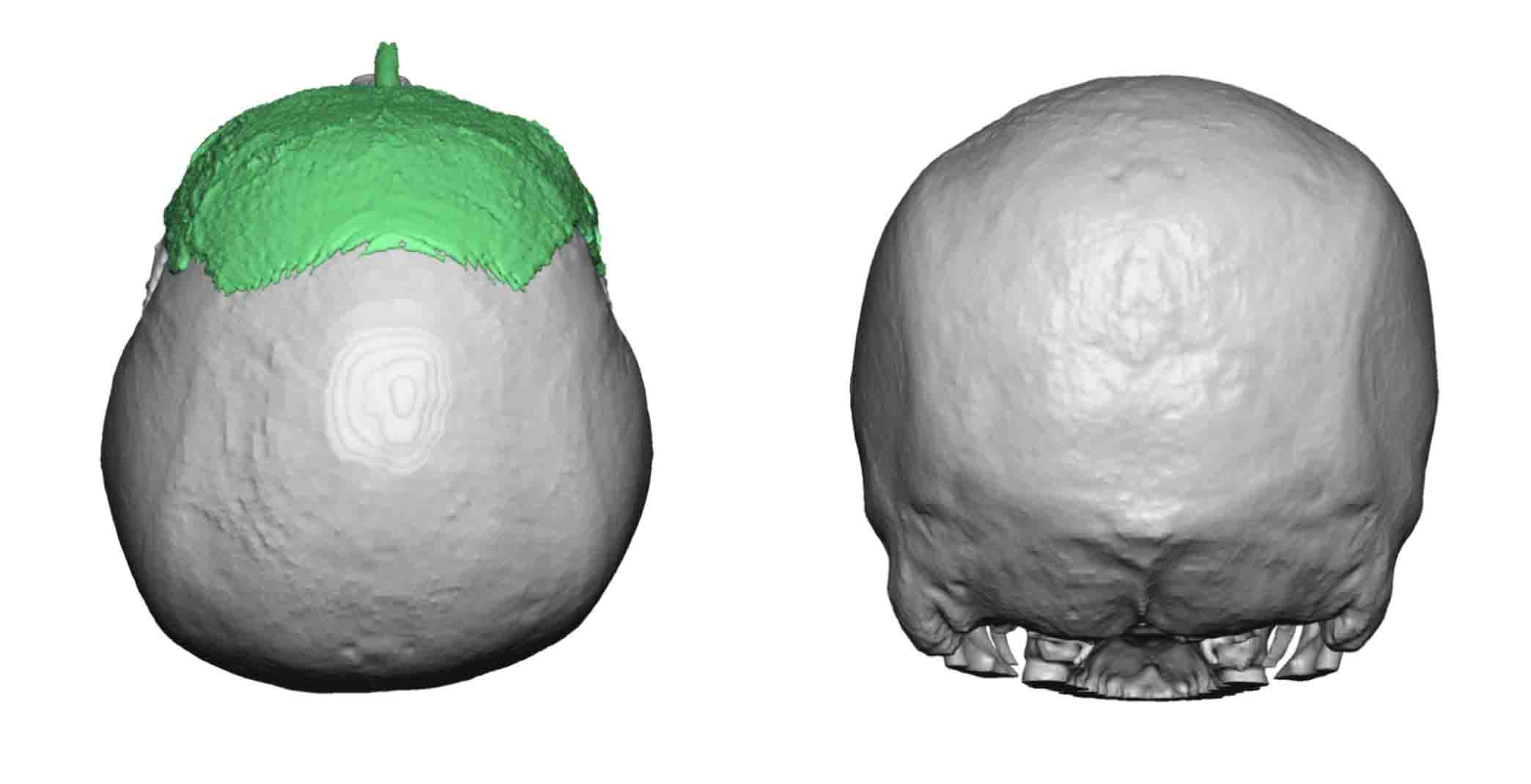 Asian Skull Shape 3D CT scan Dr Barry Eppley Indianapolis - Explore ...