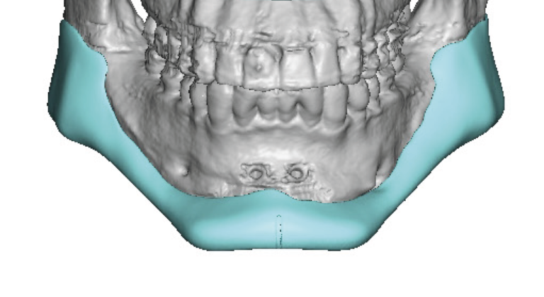 The Aesthetic Relevance of the Anterior Ramus Line in Custom Jawline ...