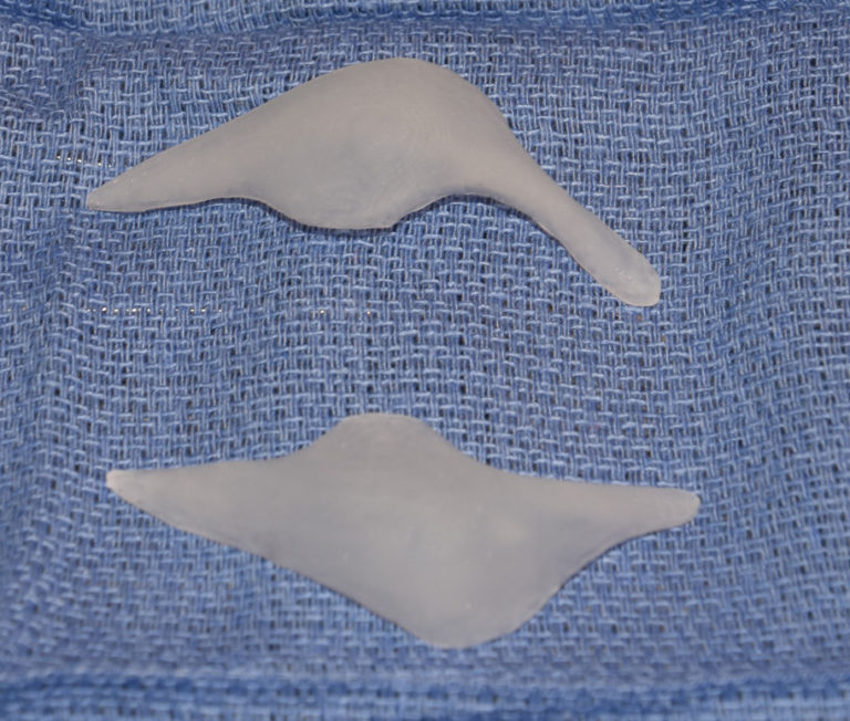 Plastic Surgery Case Study - Custom Cheek Implants with an Infraorbital ...