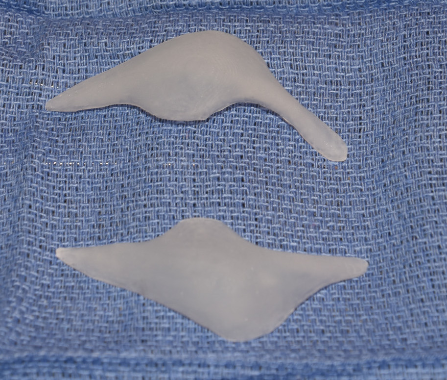 Plastic Surgery Case Study - Custom Cheek Implants with an Infraorbital ...