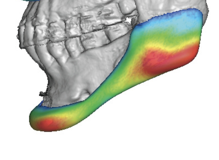 The Aesthetic Relevance of the Anterior Ramus Line in Custom Jawline ...