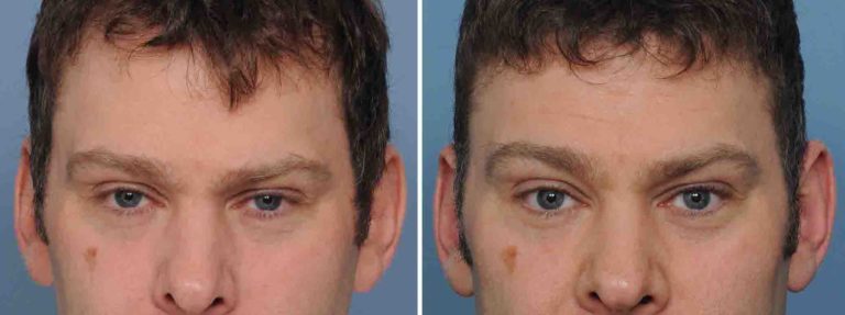 Plastic Surgery Case Study - Custom Cheek Implants with an Infraorbital ...