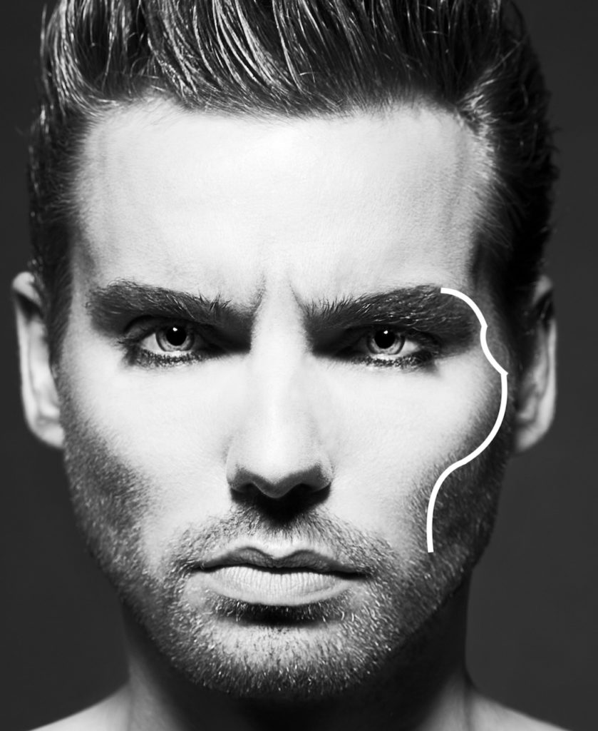 Aesthetic Insights - The Ogee Curve and Cheek/Midface Augmentation ...