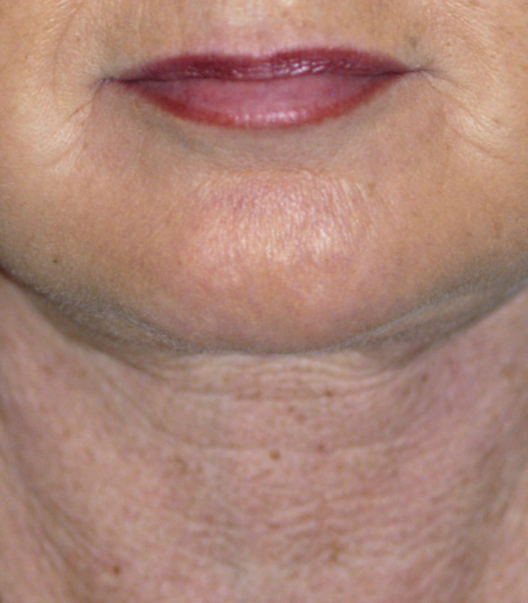 Fat-Derived Stromal Vascular Fraction (SVF) Gel vs Botox Injections for ...