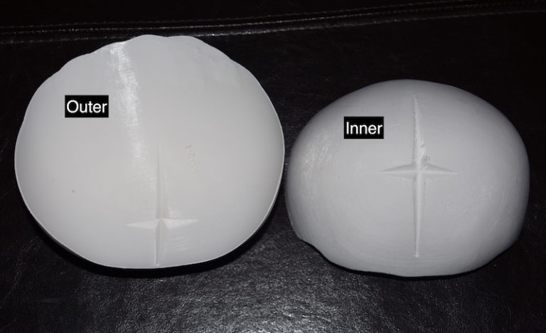 Plastic Surgery Case Study - A Two-Layer Custom Skull Implant Design ...