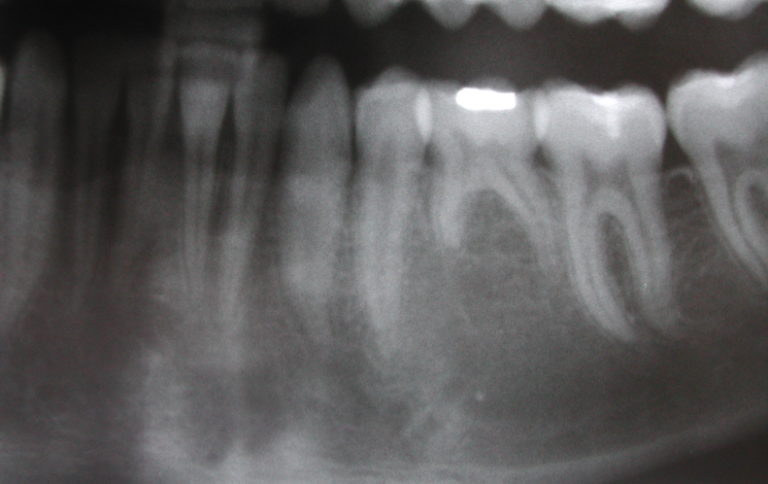 Plastic Surgery Case Study - Resorbable Plate and Screw Fixation of ...
