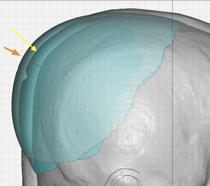 Plastic Surgery Case Study - A Two-Layer Custom Skull Implant Design ...