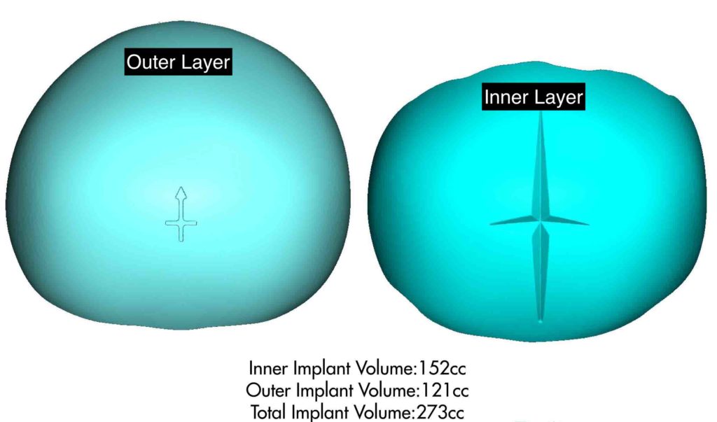 Plastic Surgery Case Study - A Two-Layer Custom Skull Implant Design ...