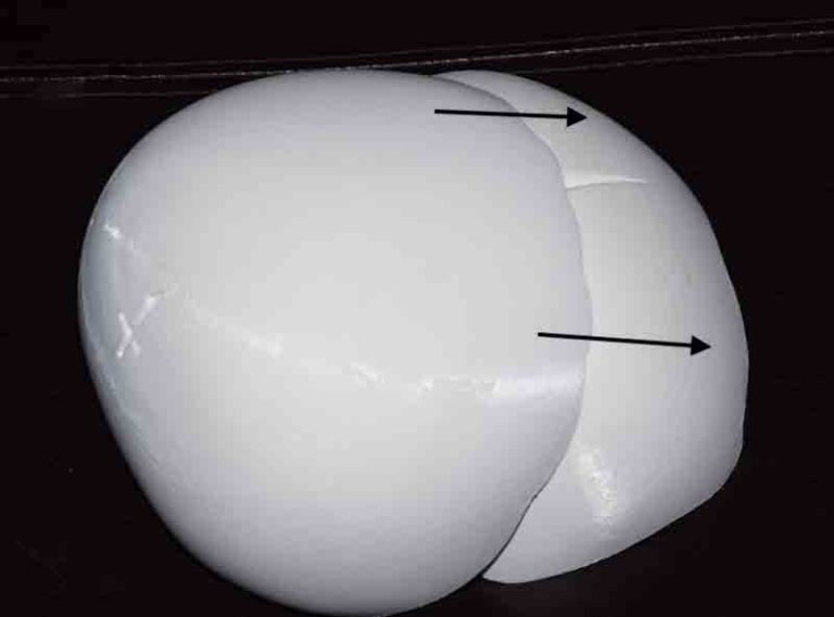 Plastic Surgery Case Study - A Two-Layer Custom Skull Implant Design ...