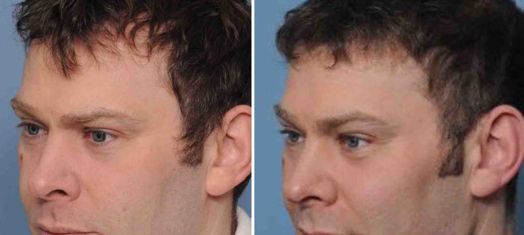 Plastic Surgery Case Study - Custom Cheek Implants with an Infraorbital ...