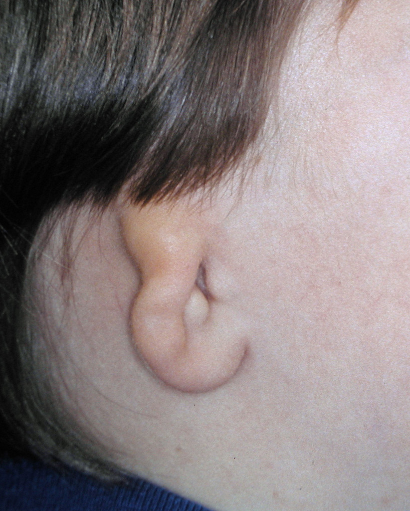 microtia ear reconstruction before Dr Barry Eppley Indianapolis ...