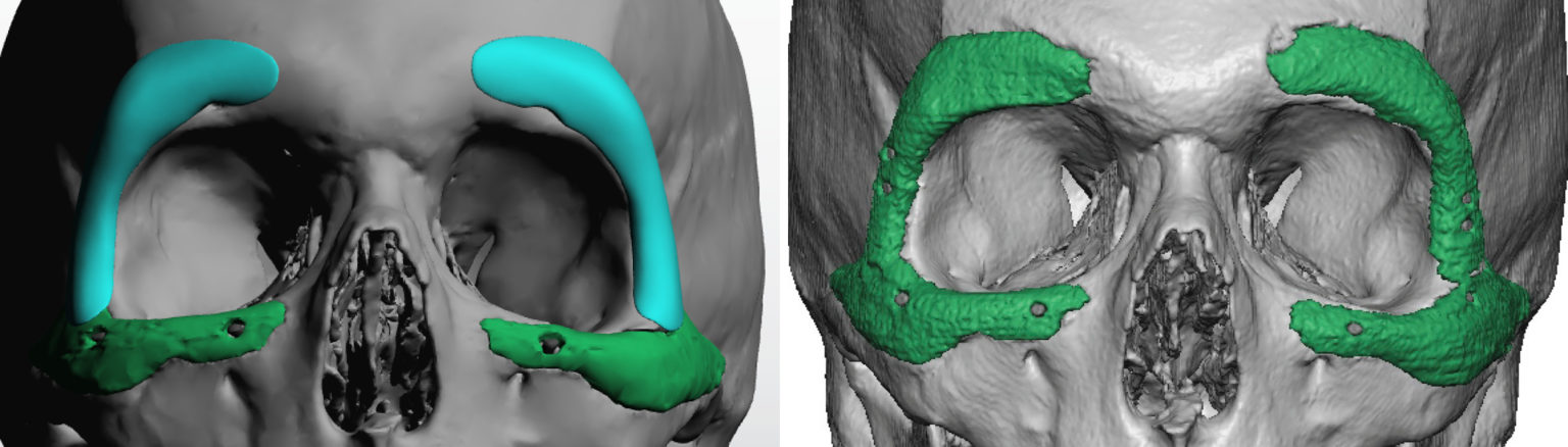 Plastic Surgery Case Study - The Addition of Custom Supralateral ...