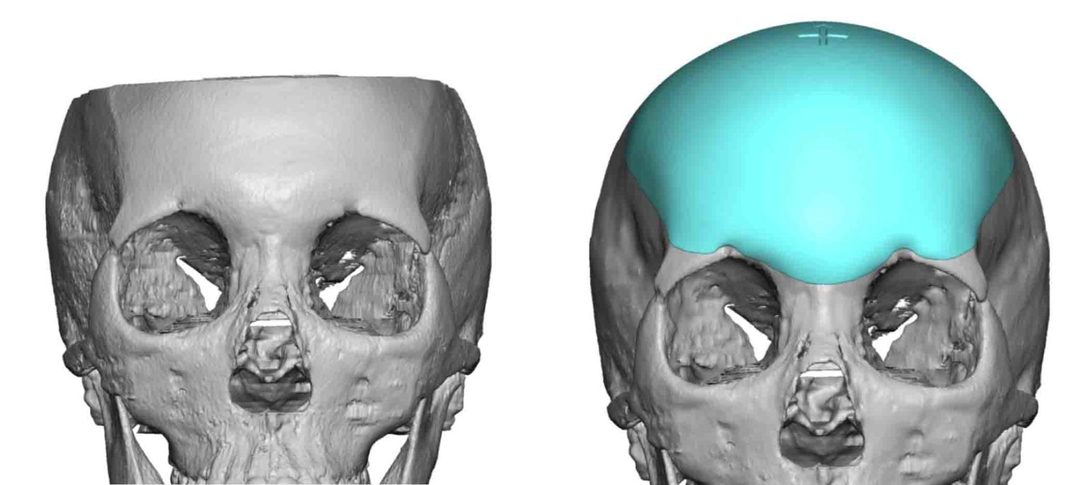 Plastic Surgery Case Study - Total Forehead Reshaping with A Custom ...