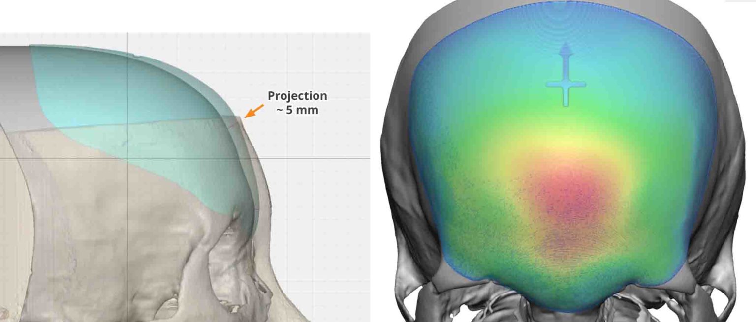 Plastic Surgery Case Study - Total Forehead Reshaping with A Custom ...