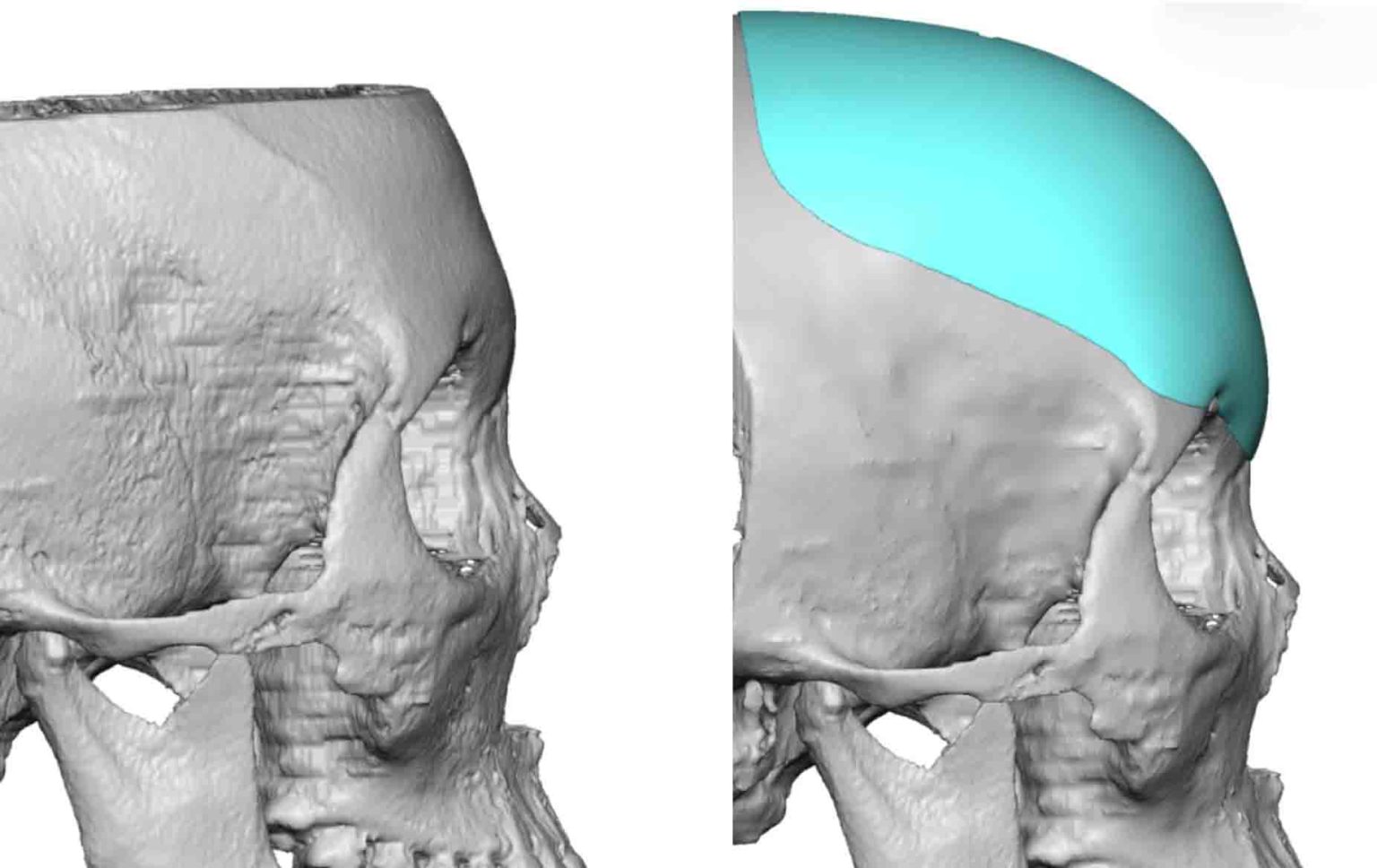 Plastic Surgery Case Study - Total Forehead Reshaping with A Custom ...