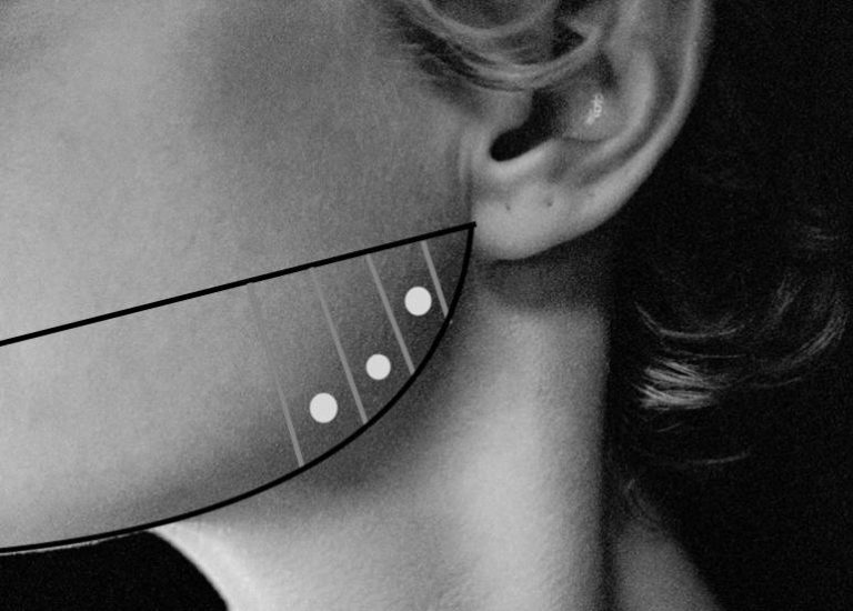 Botox Injection sites for Masseter Muscle reduction Dr Barry Eppley ...