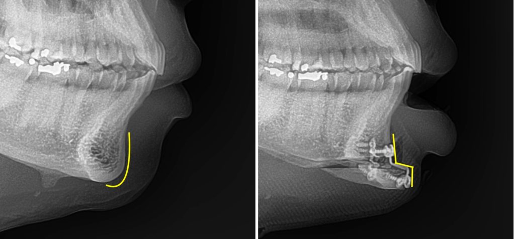 Plastic Surgery Case Study - Release of Chin Scar Contracture with ...