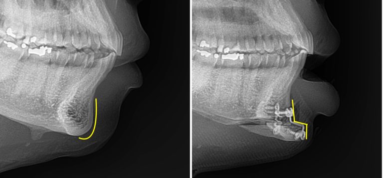 Plastic Surgery Case Study - Release of Chin Scar Contracture with ...