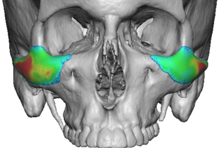 The Use of The Ogee Curve In Custom Cheek Implants Design - Explore ...