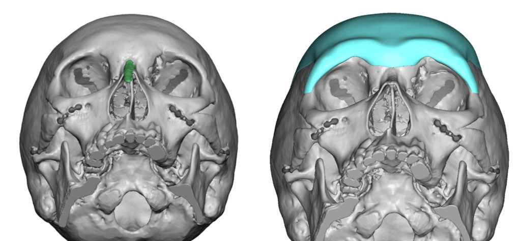 Plastic Surgery Case Study - The Design and Placement of the Custom ...