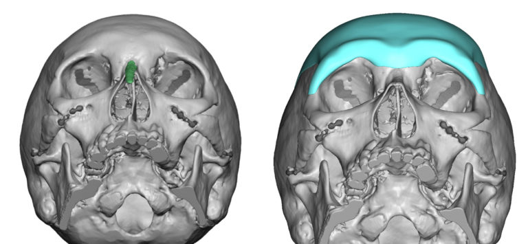 Plastic Surgery Case Study - The Design and Placement of the Custom ...
