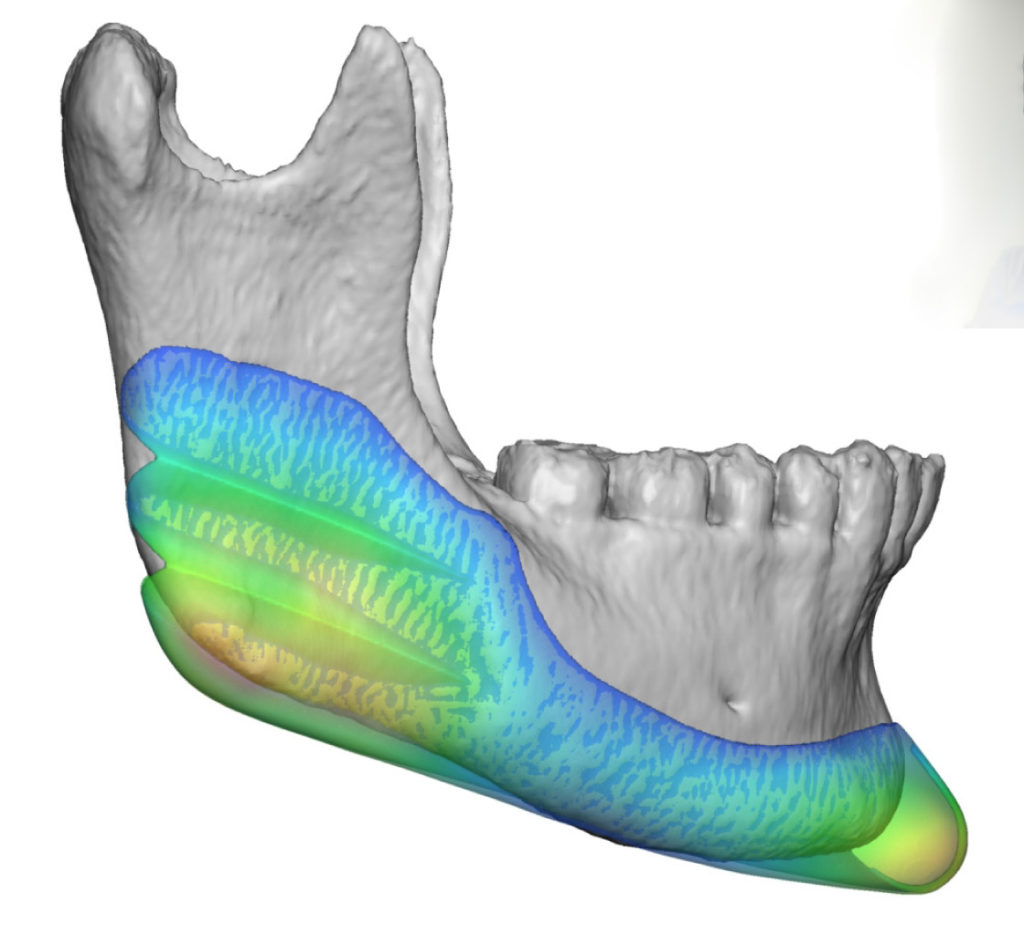 Custom Jawline Implant design for Jaw Asymmetry side view color ...