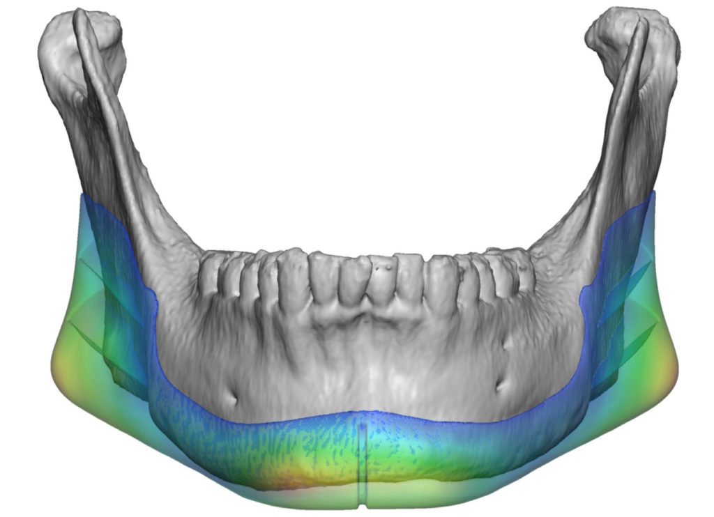 Plastic Surgery Case Study - Male Custom Jawline Implant with Internal ...