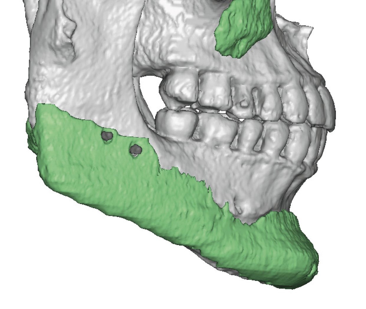 Plastic Surgery Case Study - Custom Jawline Implant Replacement of ...
