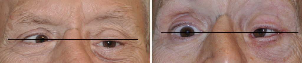 Custom Orbital Floor Implant for Vertical Orbital Dystopia Correction ...