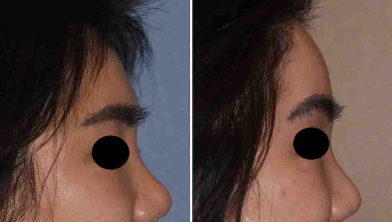 Plastic Surgery Case Study - Total Forehead Reshaping with A Custom ...