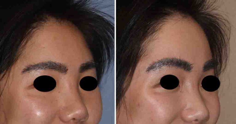 Plastic Surgery Case Study - Total Forehead Reshaping with A Custom ...