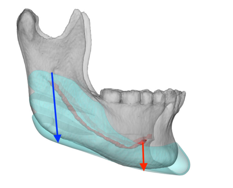 Plastic Surgery Case Study - Male Custom Jawline Implant with Internal ...
