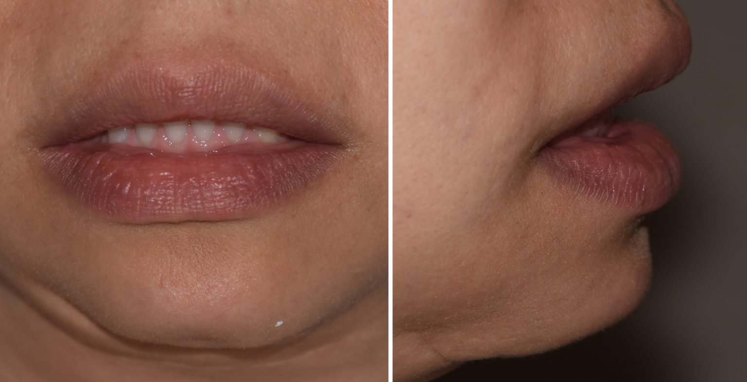 Lower Lip Sag After Genioplasty Dr Barry Eppley Indianapolis - Explore ...