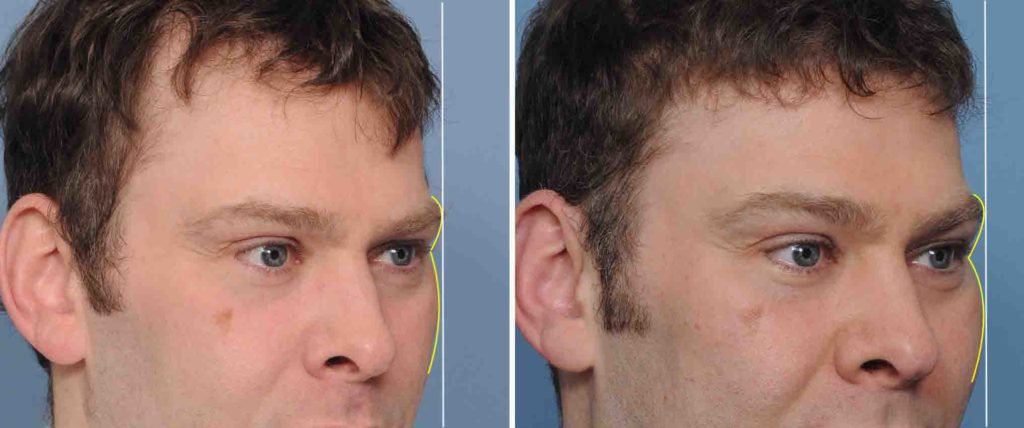 The Use of The Ogee Curve In Custom Cheek Implants Design - Explore ...